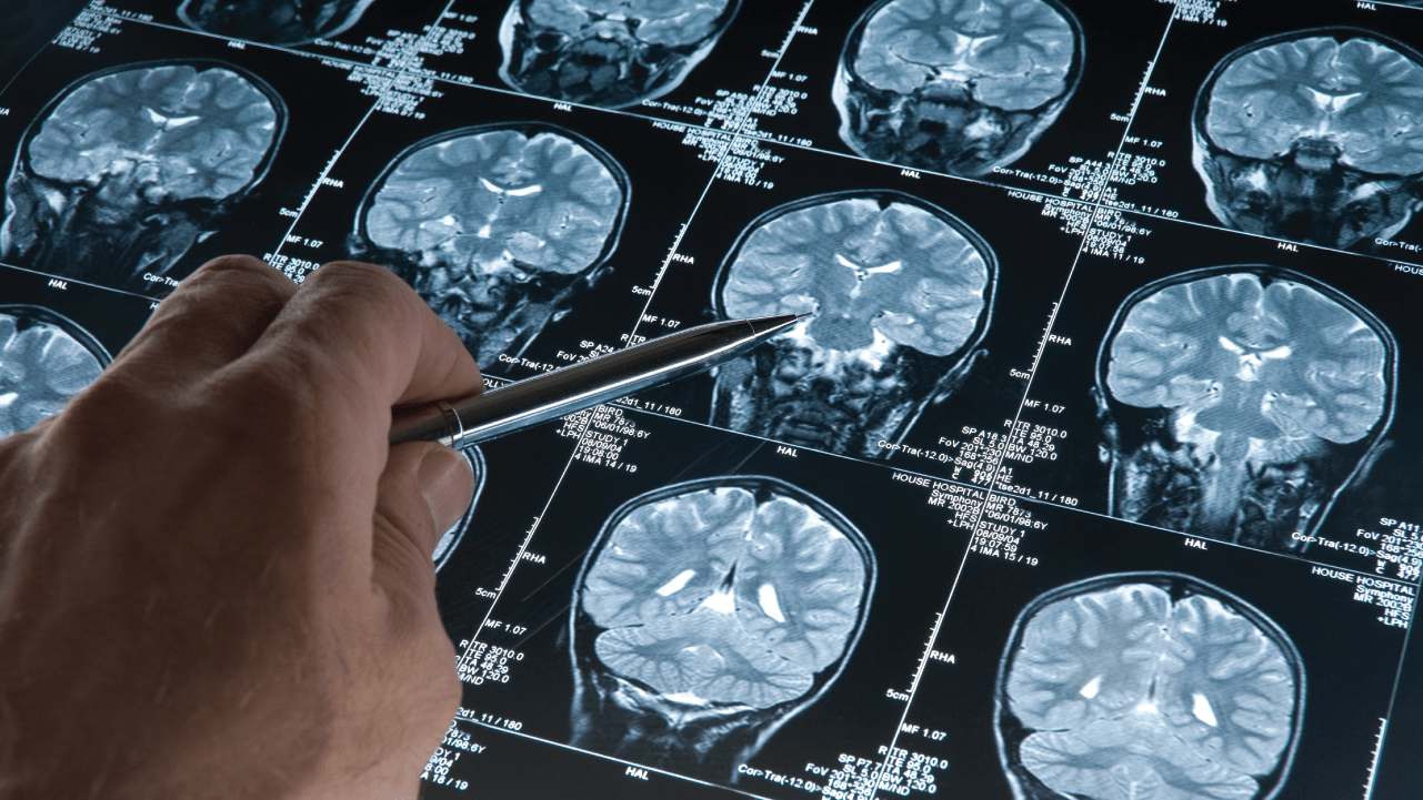 Public cautious about enhancing cognitive function using computer chip ...